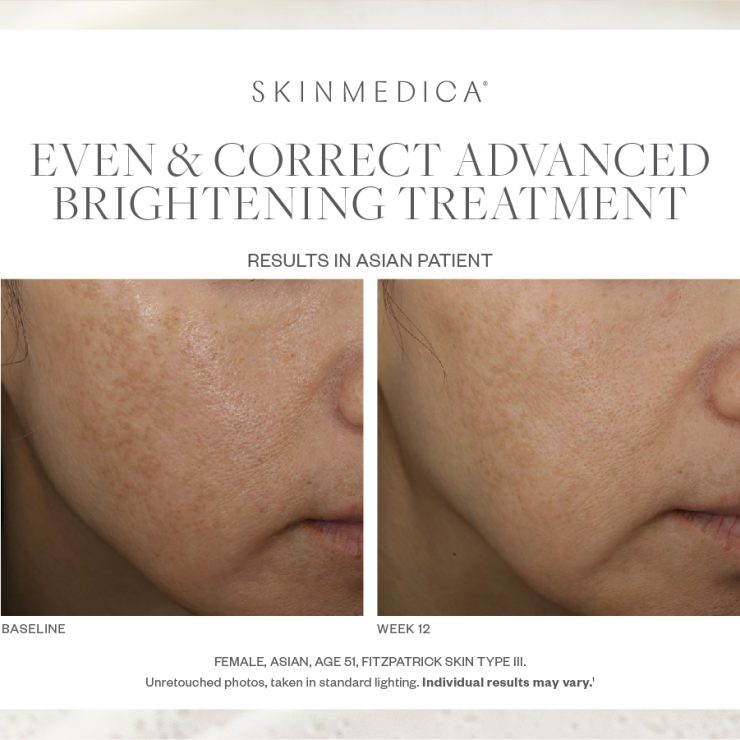 Even & Correct Advanced Brightening Treatment – South Coast Dermatology ...